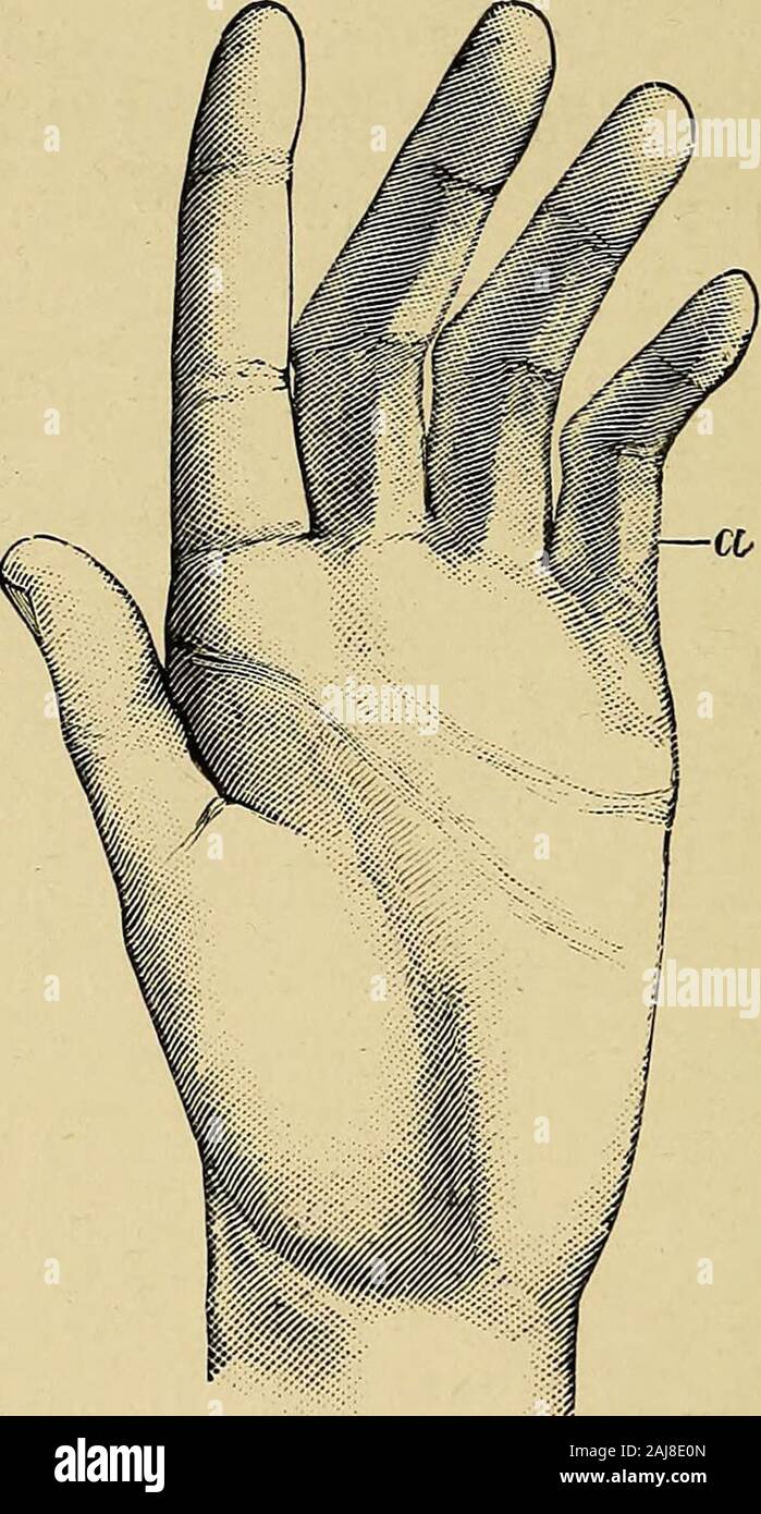 Skin contraction hi-res stock photography and images - Alamy