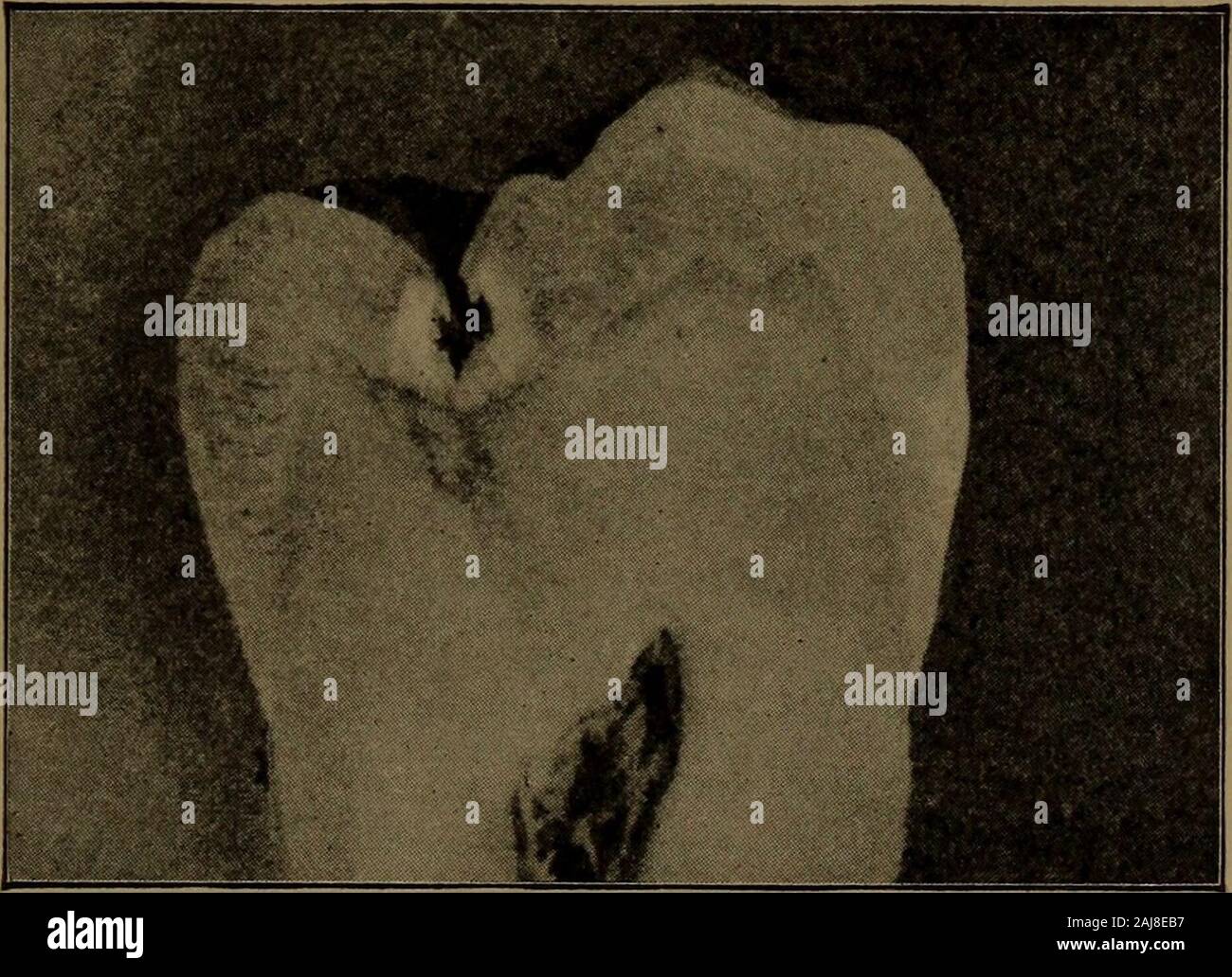 Tooth enamel defect hi-res stock photography and images - Alamy