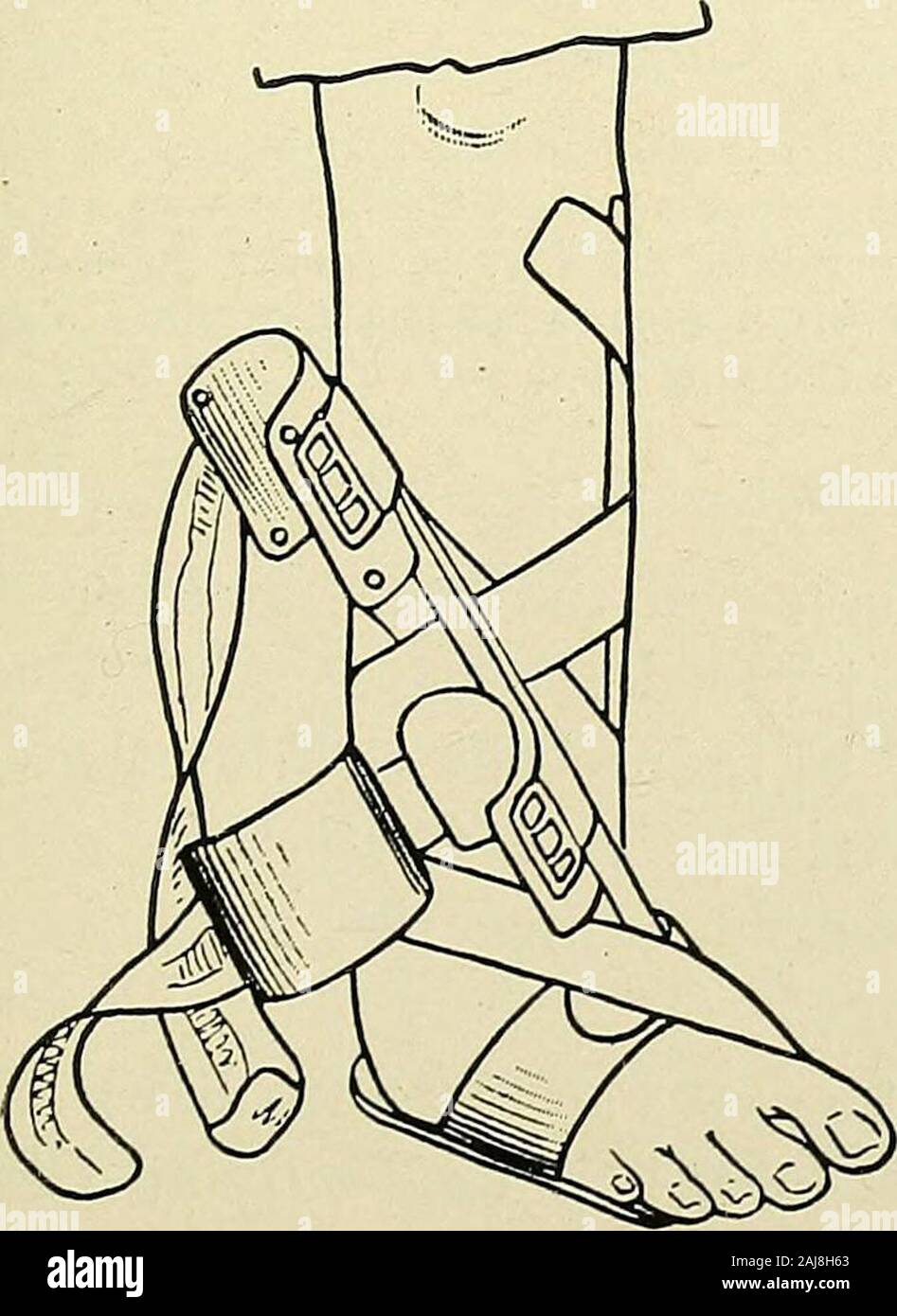 Club foot brace hi-res stock photography and images - Alamy