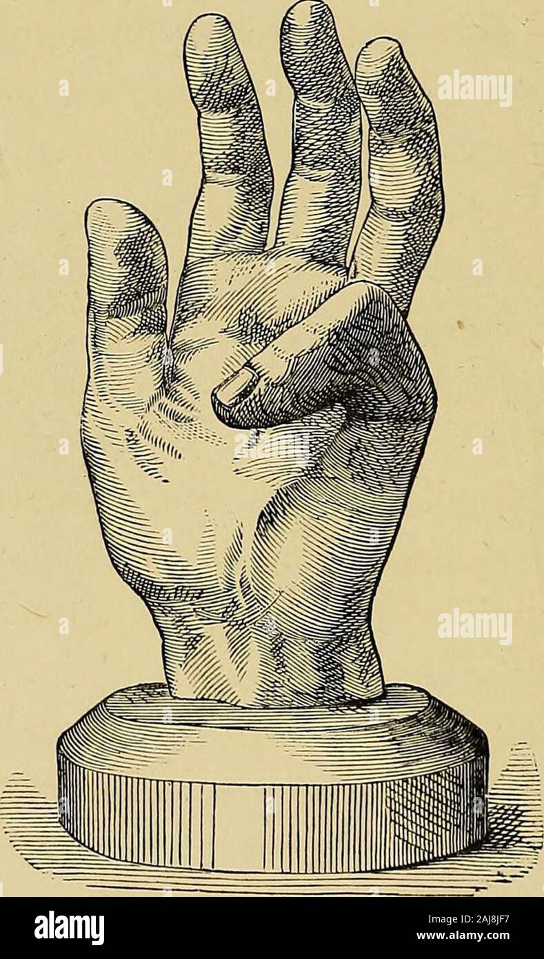 On contractions of the fingers (Dupuytren's and congenital contractions ...