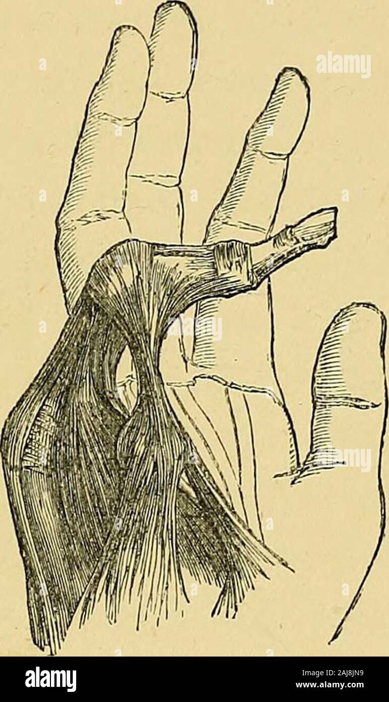 On contractions of the fingers (Dupuytren's and congenital contractions ...