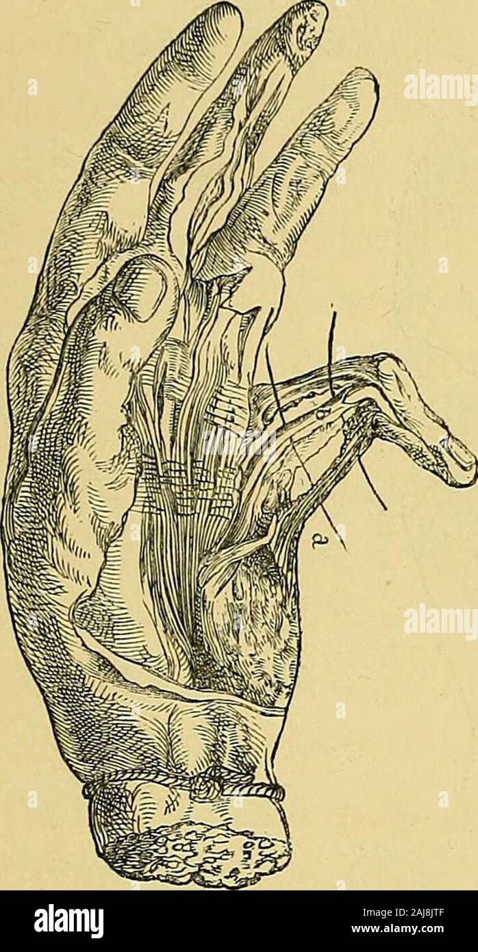 On contractions of the fingers (Dupuytren's and congenital contractions ...