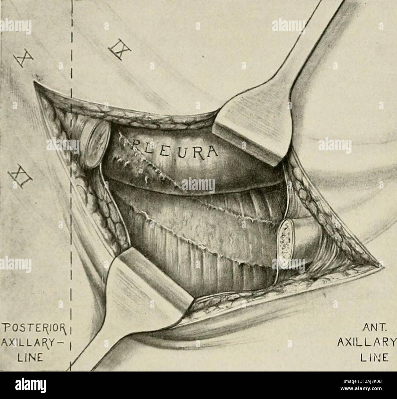 Abscess and cellulitis hi-res stock photography and images - Alamy