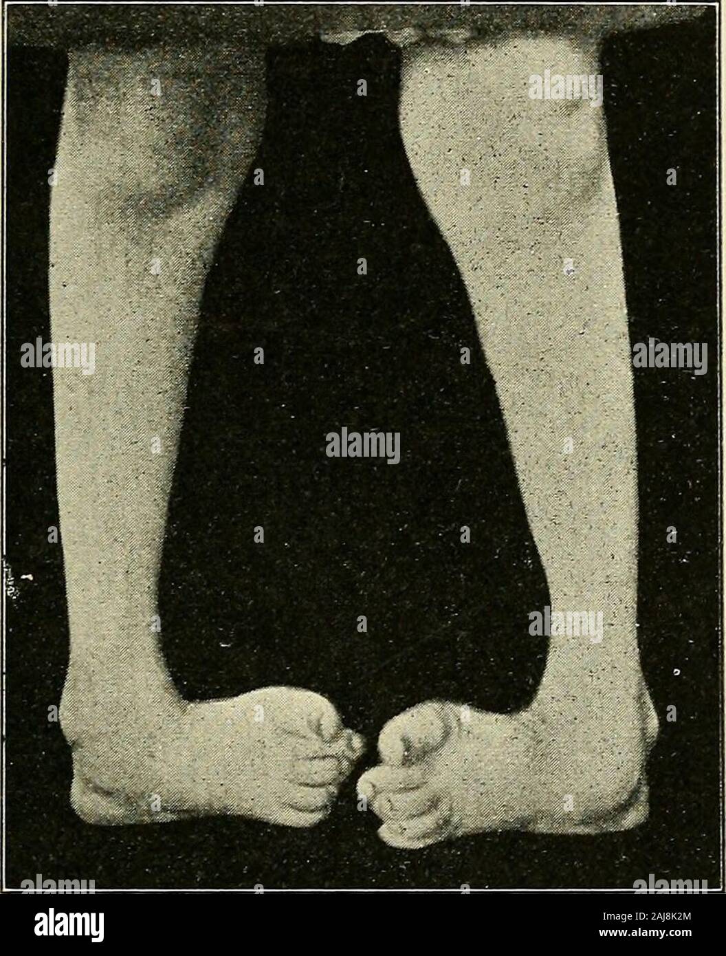 Cotton between toes hi-res stock photography and images - Alamy