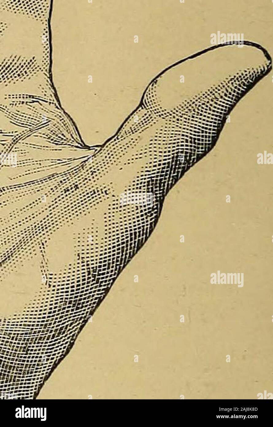 On contractions of the fingers (Dupuytren's and congenital contractions ...