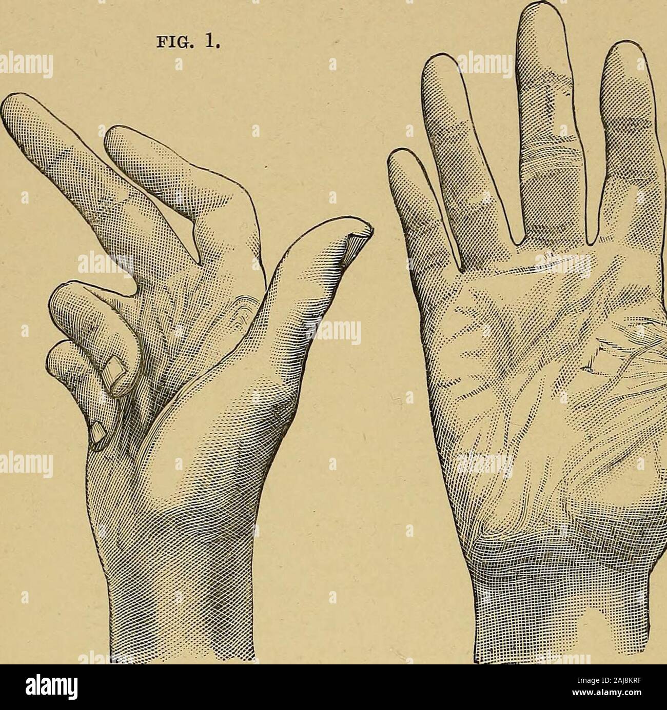 On contractions of the fingers (Dupuytren's and congenital contractions ...