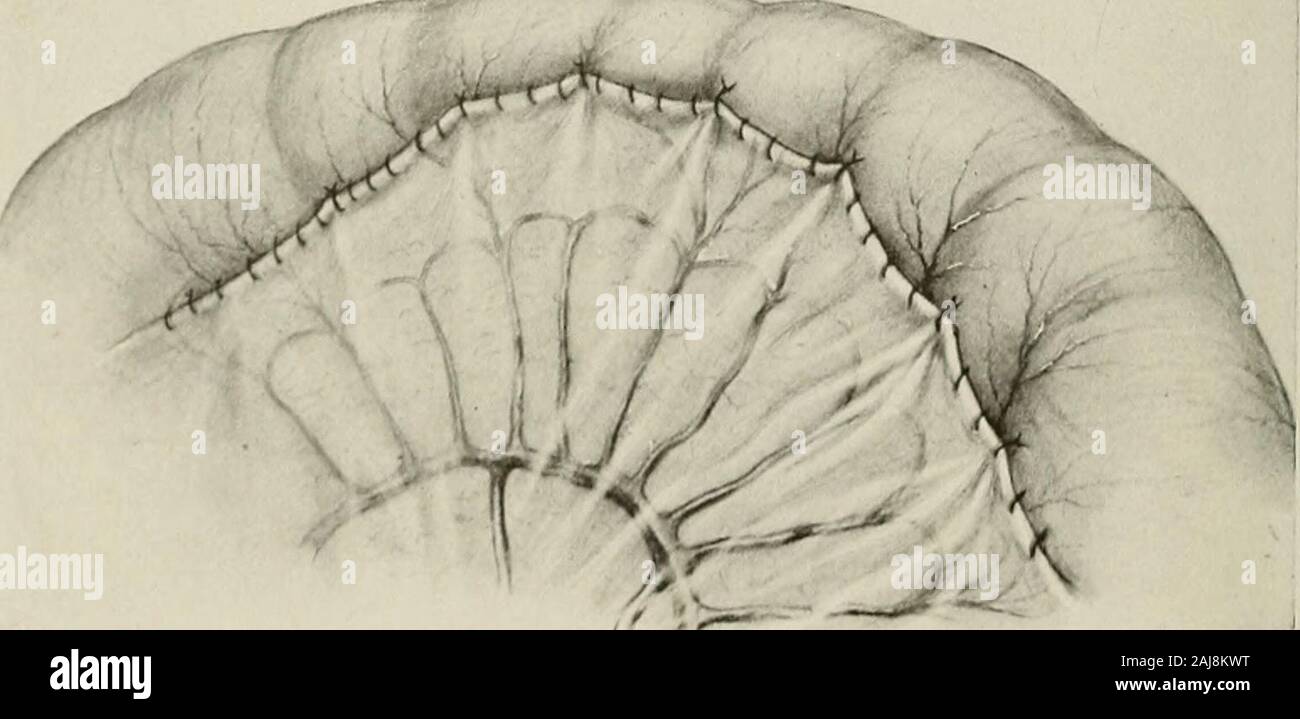 Omental hi-res stock photography and images - Alamy