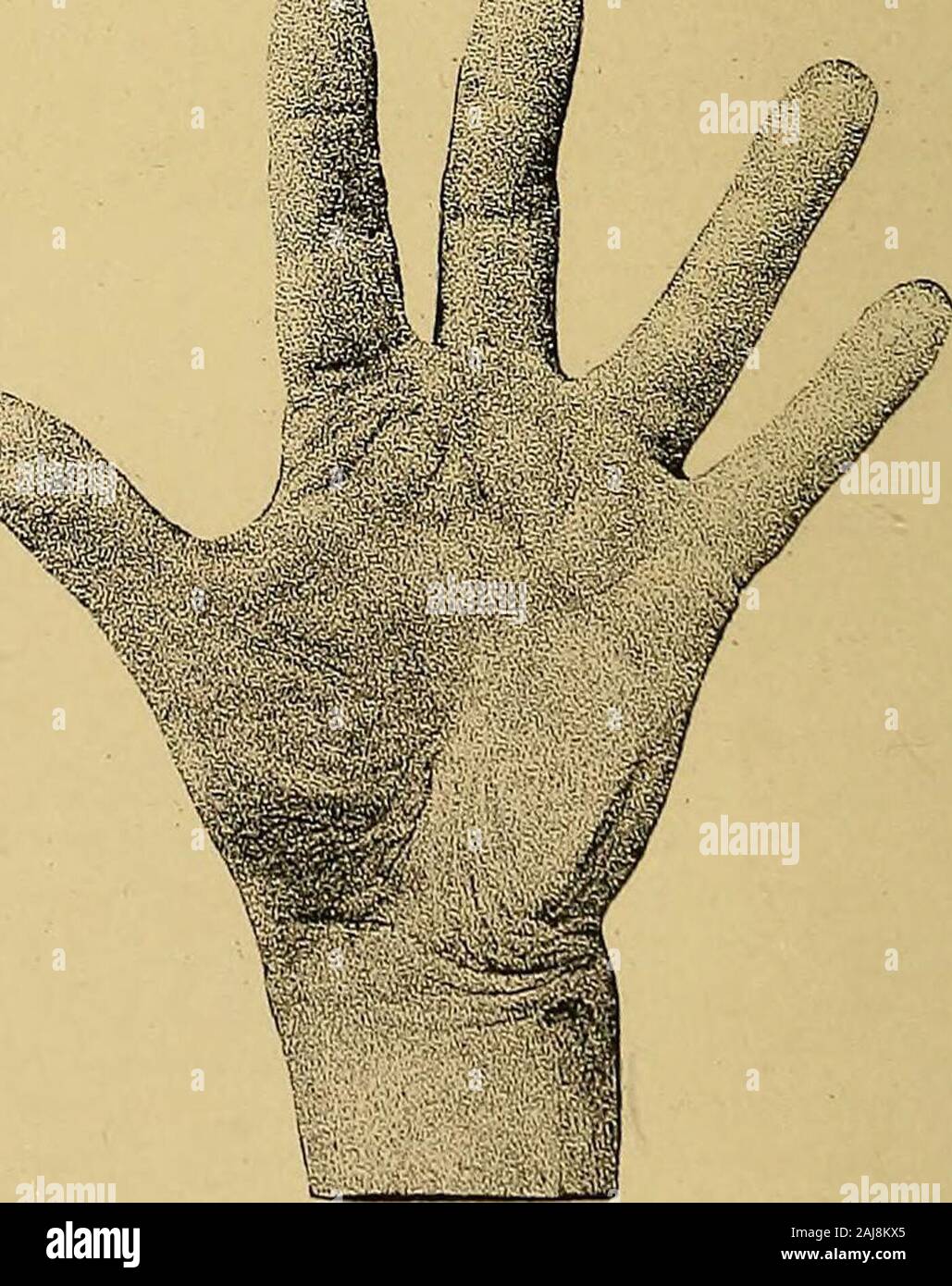 On contractions of the fingers (Dupuytren's and congenital contractions ...