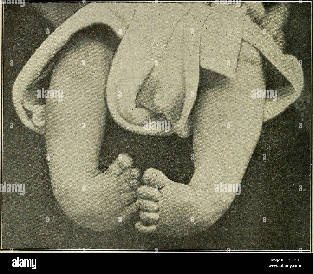 A treatise on orthopedic surgery . e is abnormally concave, and ...