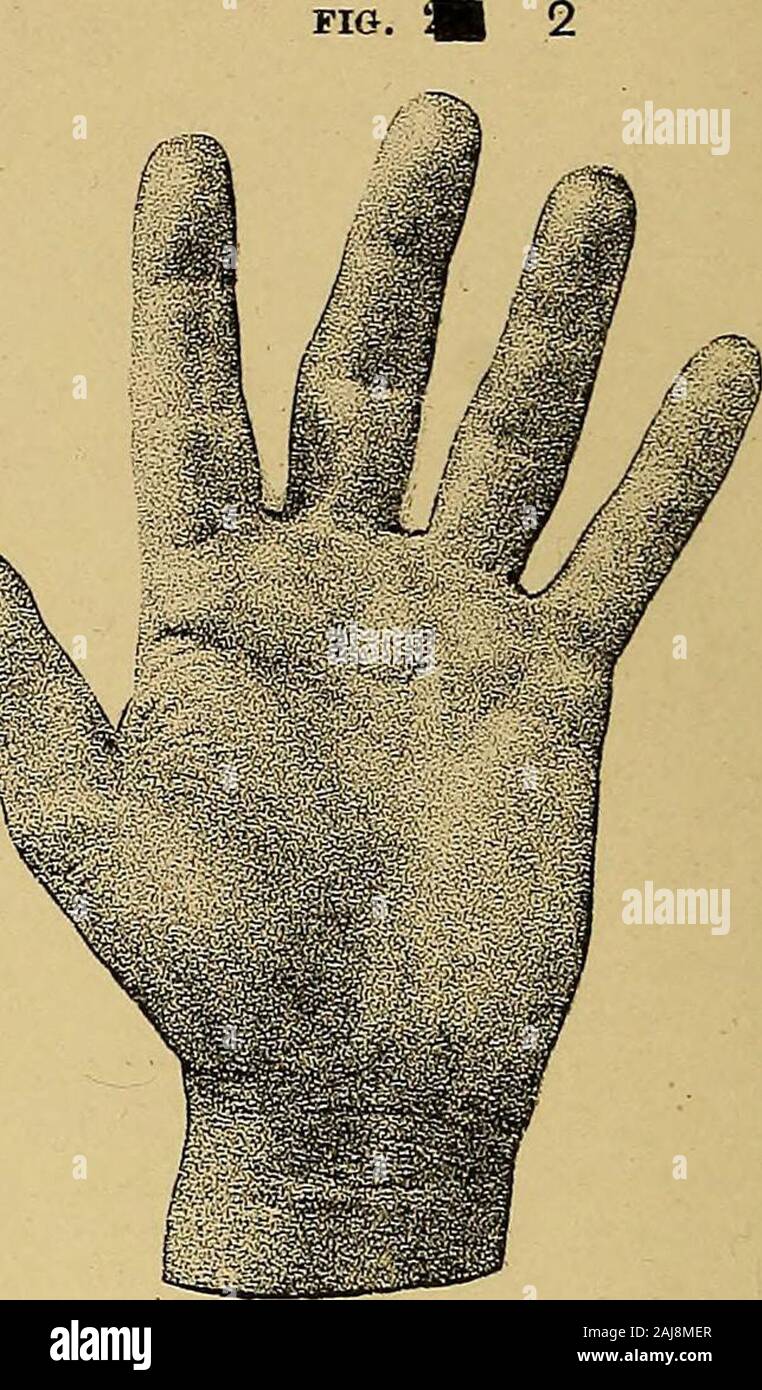 On contractions of the fingers (Dupuytren's and congenital contractions ...