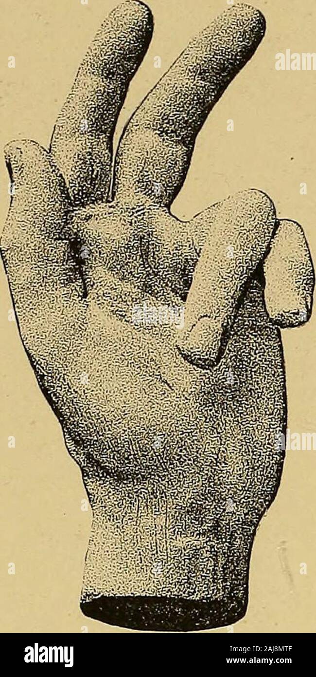 On contractions of the fingers (Dupuytren's and congenital contractions ...