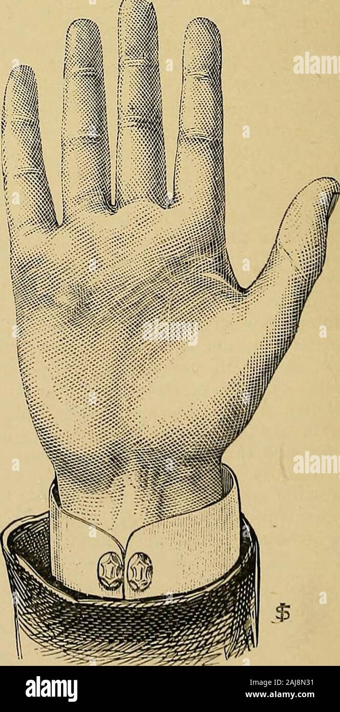 On contractions of the fingers (Dupuytren's and congenital contractions ...