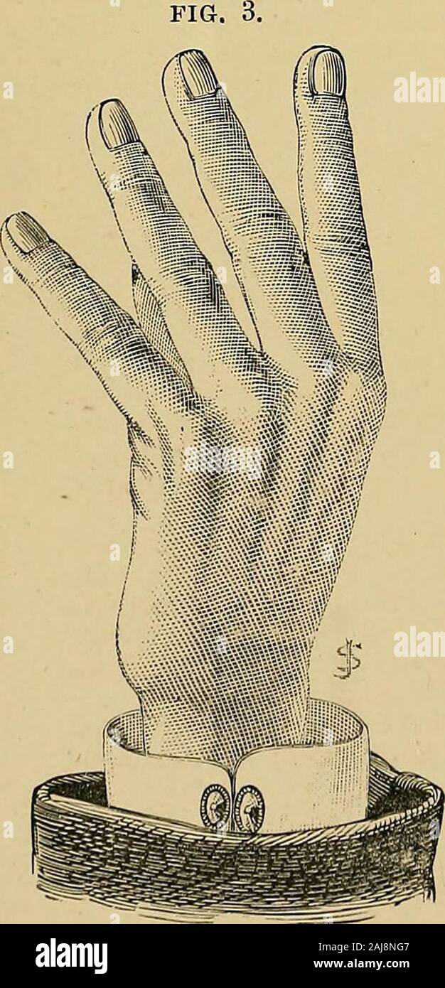 On contractions of the fingers (Dupuytren's and congenital contractions ...