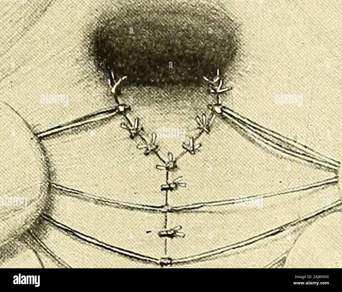 Operative gynecology : . Fig. 156.—Complete Tear of the Recto-vaginal ...