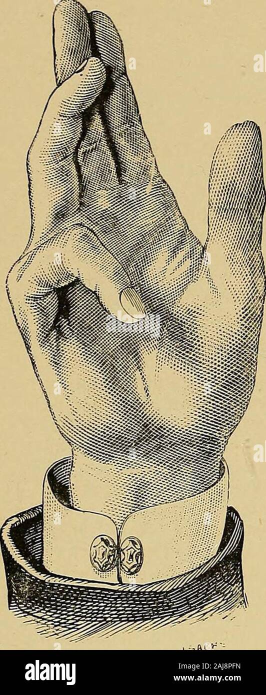 On contractions of the fingers (Dupuytren's and congenital contractions ...