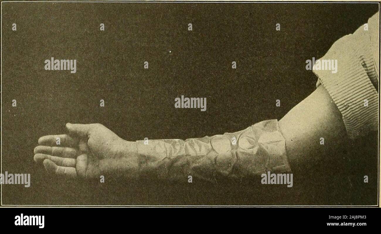 Wound secretion hi-res stock photography and images - Alamy