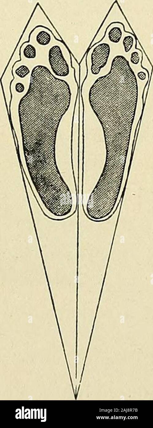A treatise on orthopedic surgery . Shoemakers feet. Shoemakers soles ...
