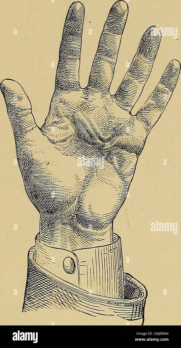 On contractions of the fingers (Dupuytren's and congenital contractions ...