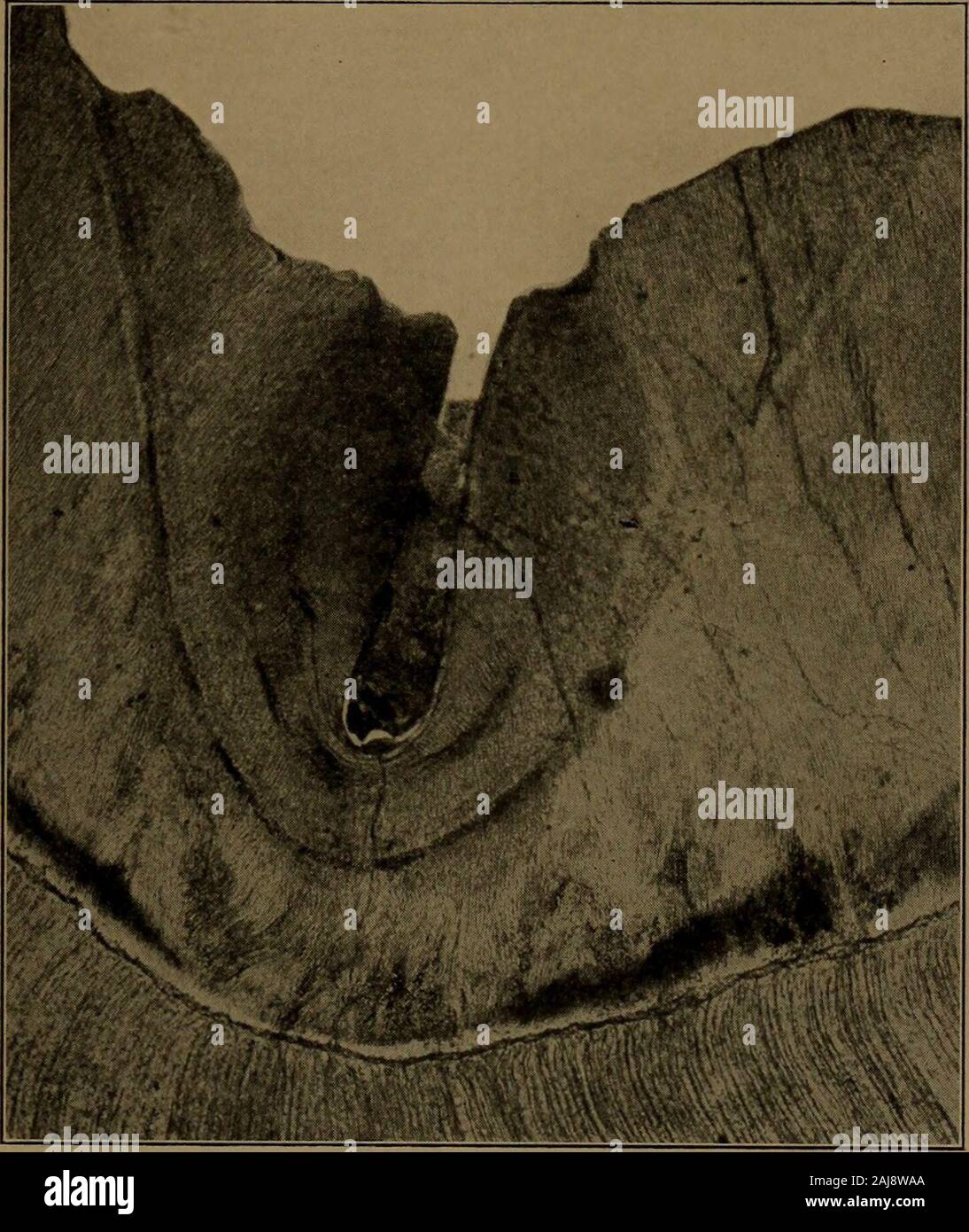 Tooth enamel defect hi-res stock photography and images - Alamy