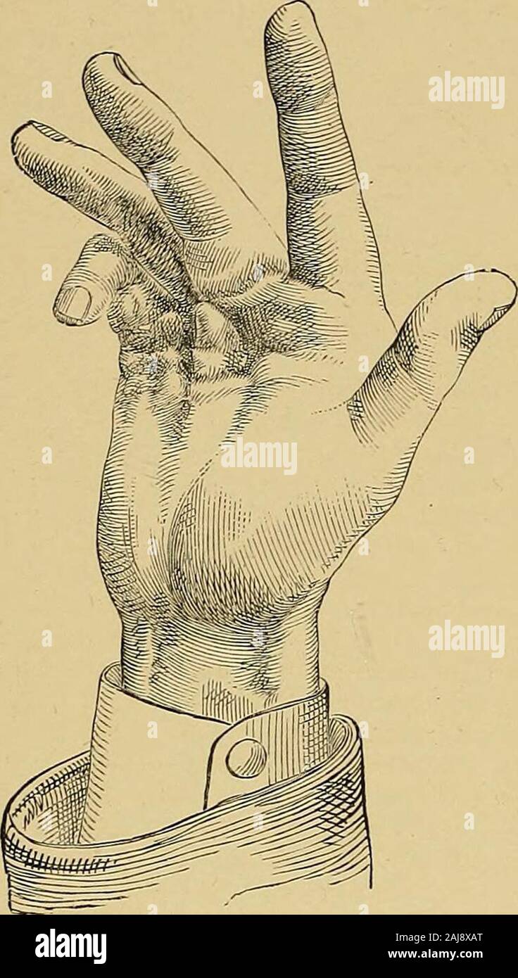 On contractions of the fingers (Dupuytren's and congenital contractions ...
