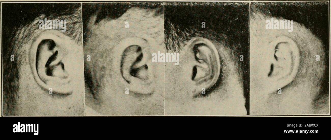 Plastic surgery; its principles and practice . Fig. 432.—Unilateral ...