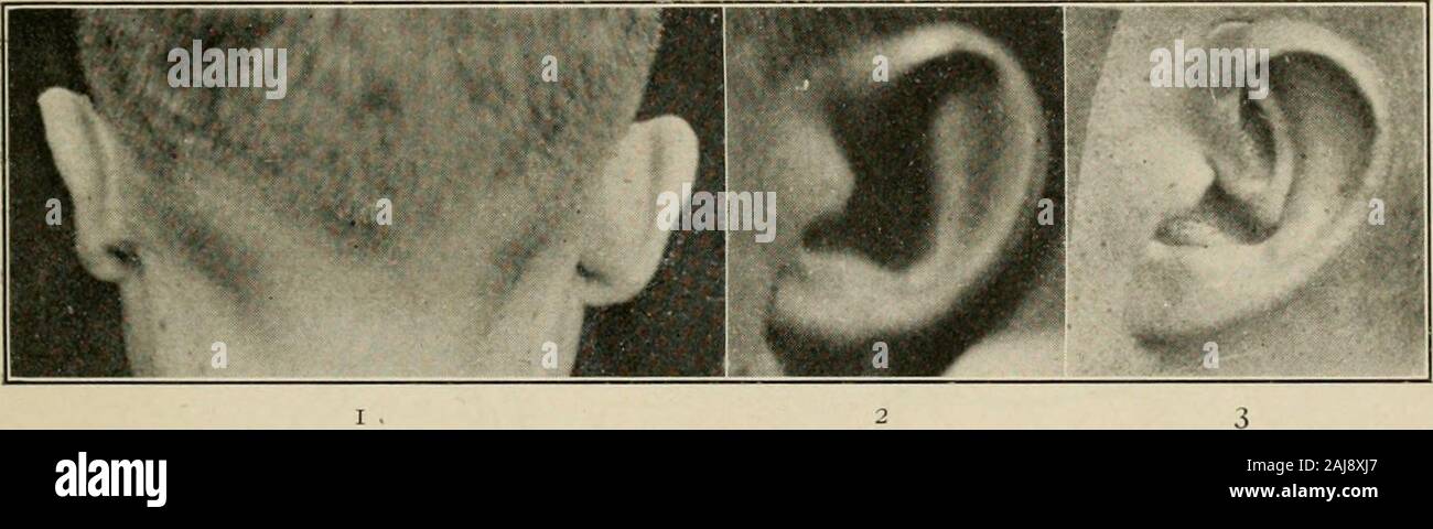 Antihelix High Resolution Stock Photography and Images - Alamy