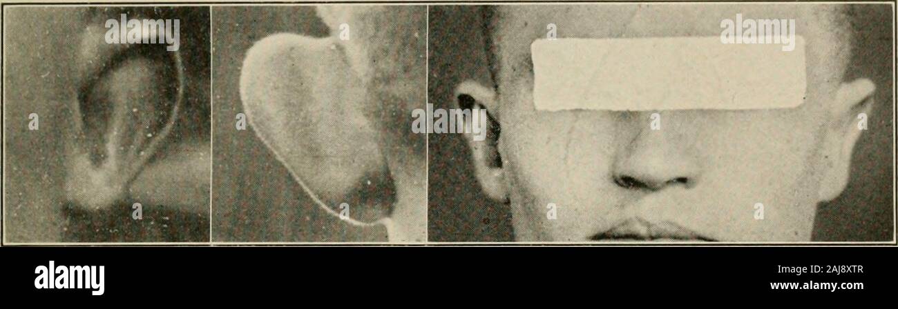 Antihelix High Resolution Stock Photography and Images - Alamy