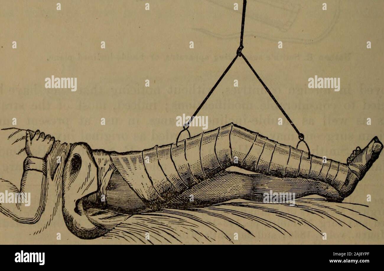 Smiths anterior splint hi-res stock photography and images - Alamy