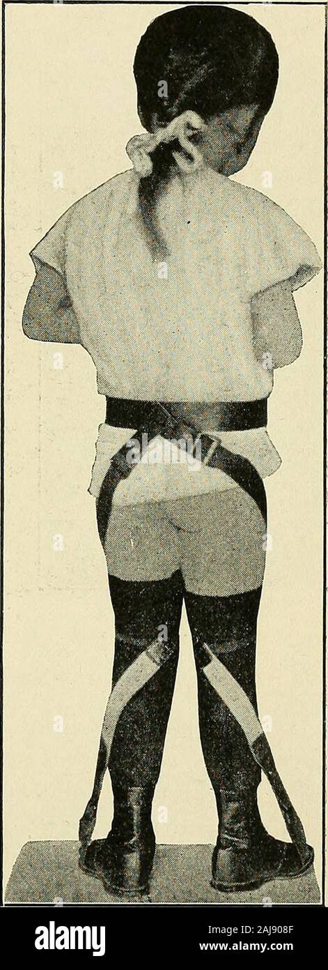 A treatise on orthopedic surgery . allux varus formsone variety of what ...