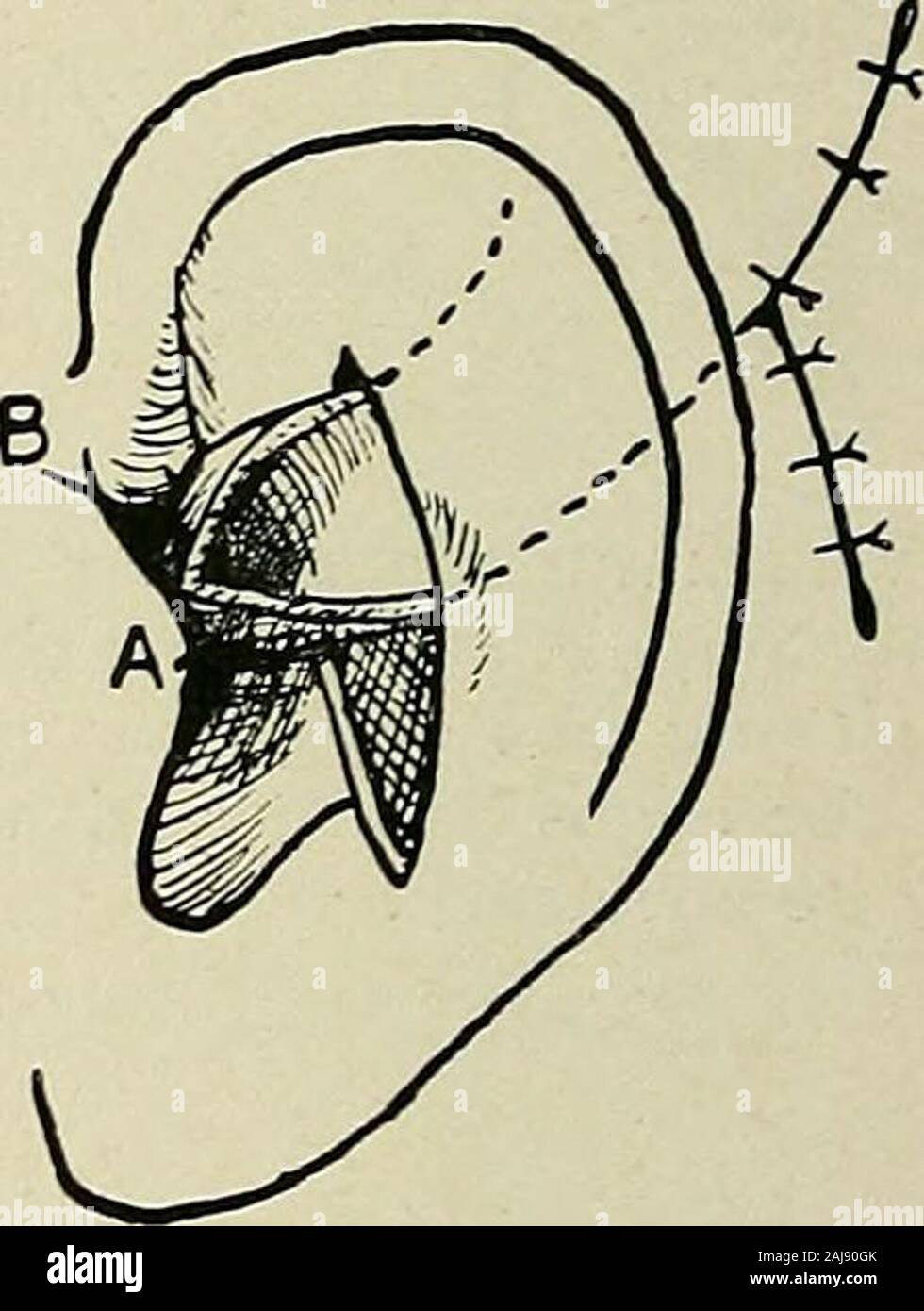 Plastic surgery; its principles and practice . Fig. 425.—Operation for ...