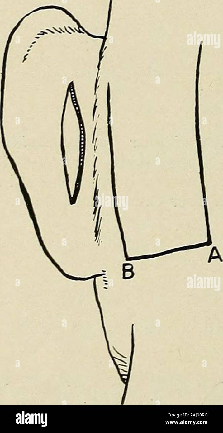 Plastic surgery; its principles and practice . pedicle. Turn the flap ...