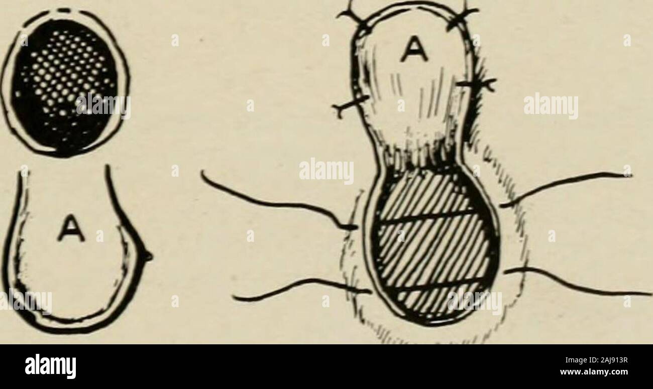 Plastic surgery; its principles and practice . if/fiitiiiii I 2 3 Fig ...