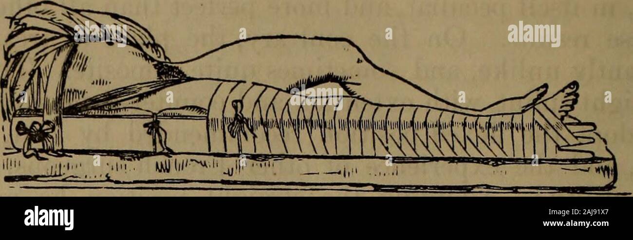 A practical treatise on fractures and dislocations . f the ...