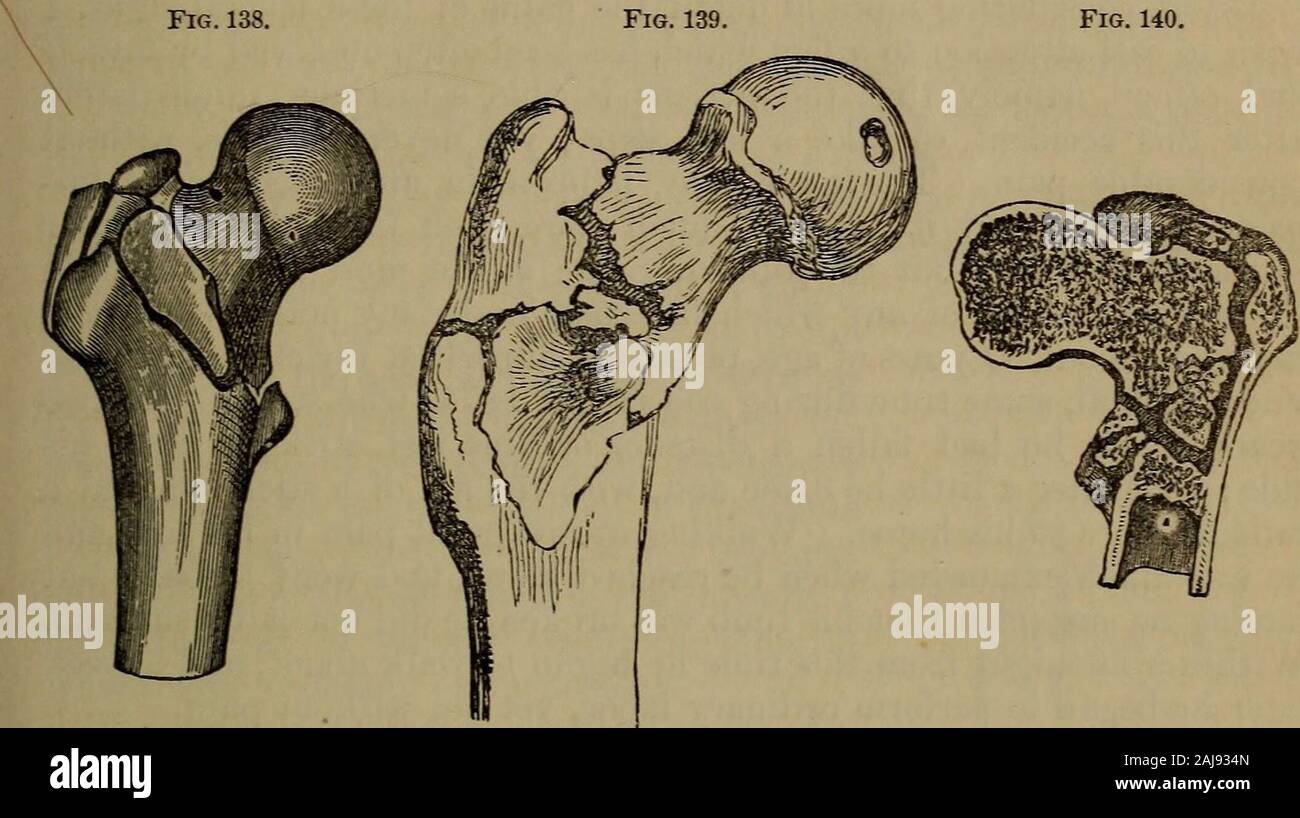 Trochanter major hi-res stock photography and images - Alamy