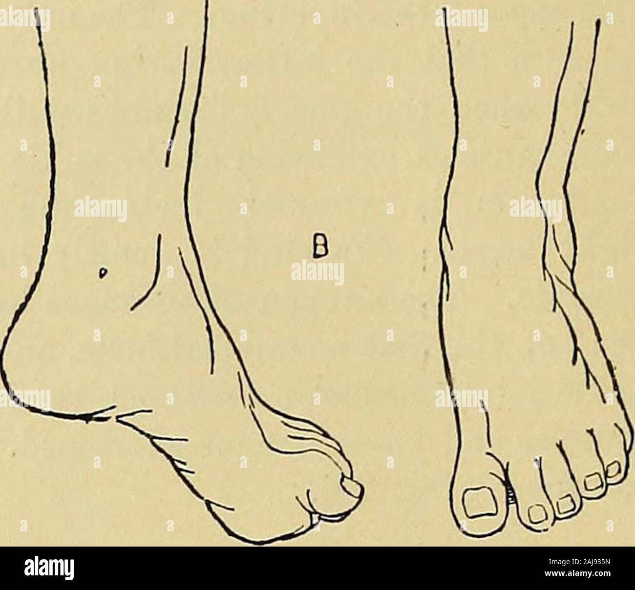 Valgus Vs Varus Of Ankle