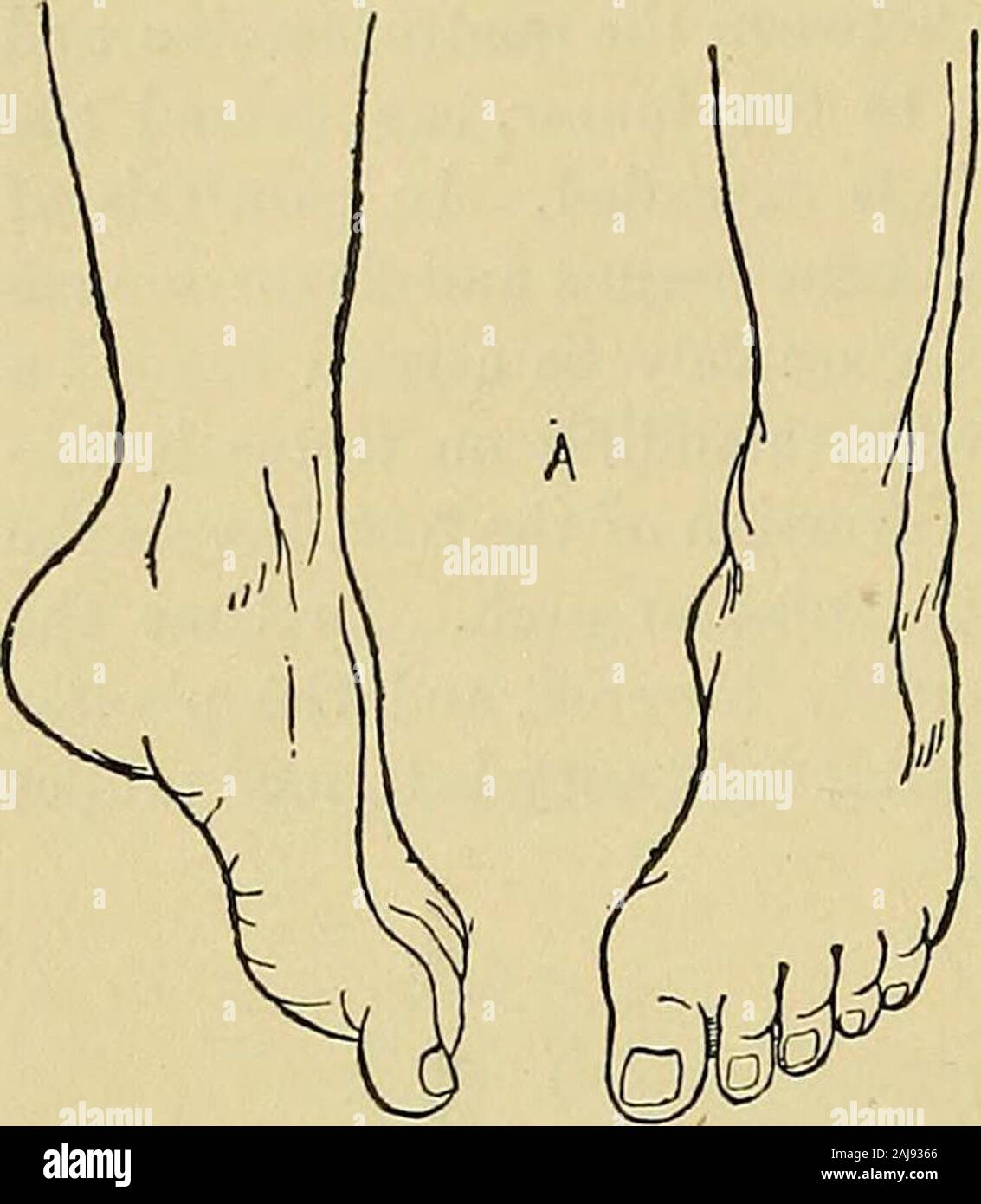 Abduction Of Foot