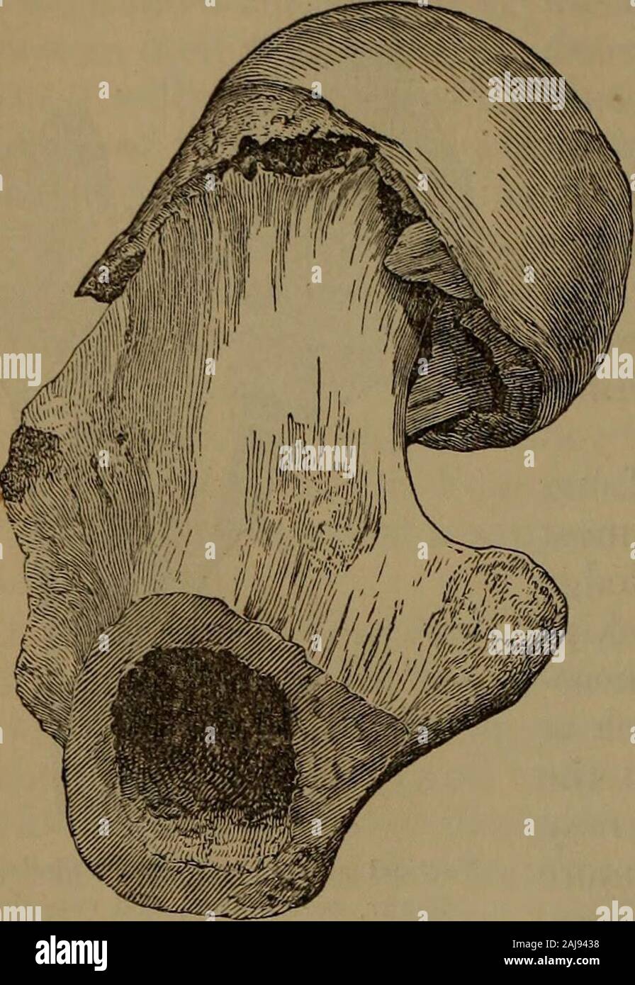 Intracapsular fractures hi-res stock photography and images - Alamy