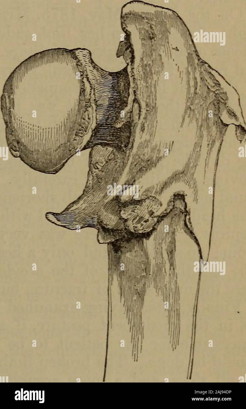 Neck of femur fractures hi-res stock photography and images - Alamy