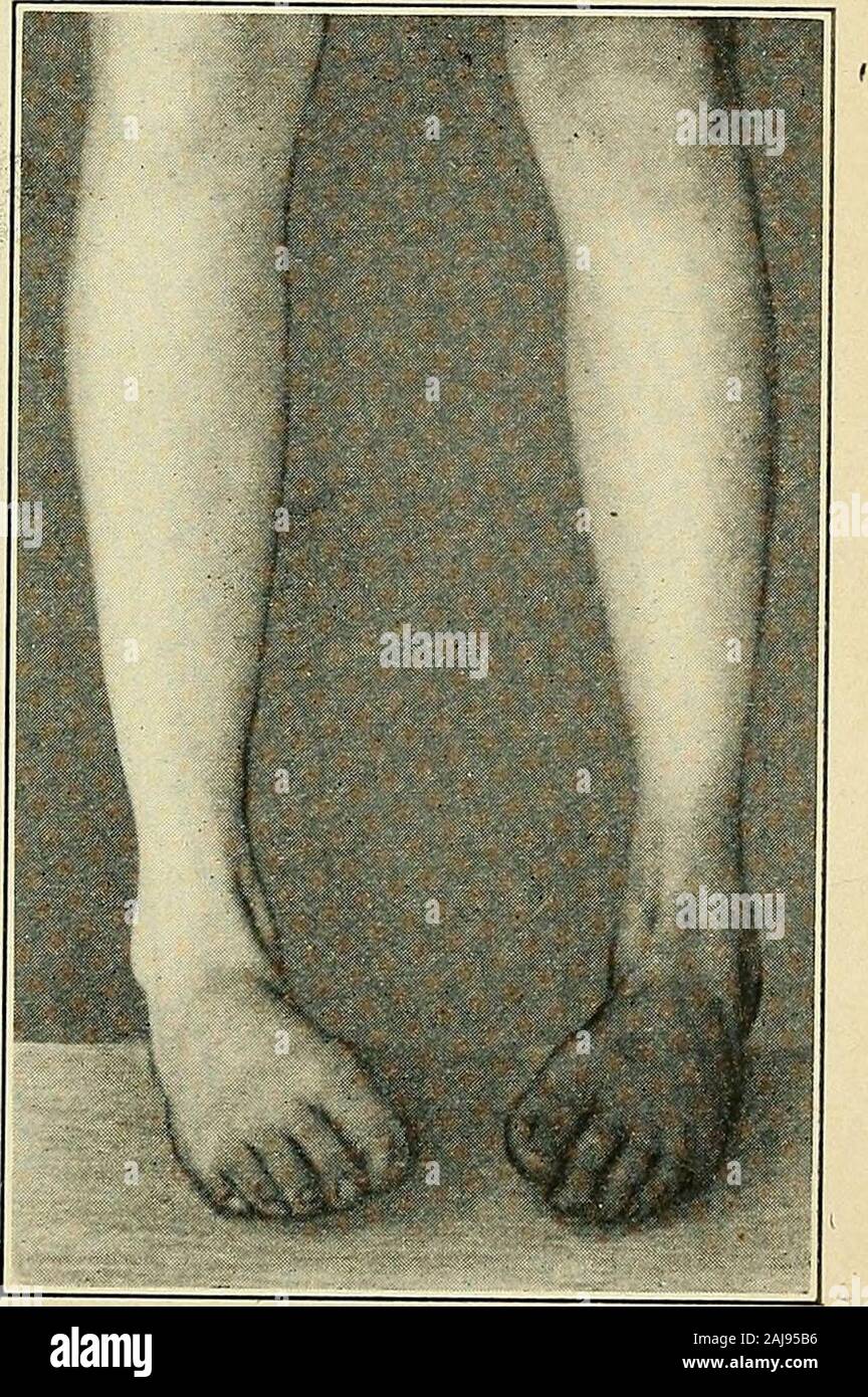 A treatise on orthopedic surgery . The tip-toe exercise, rai.siug the ...