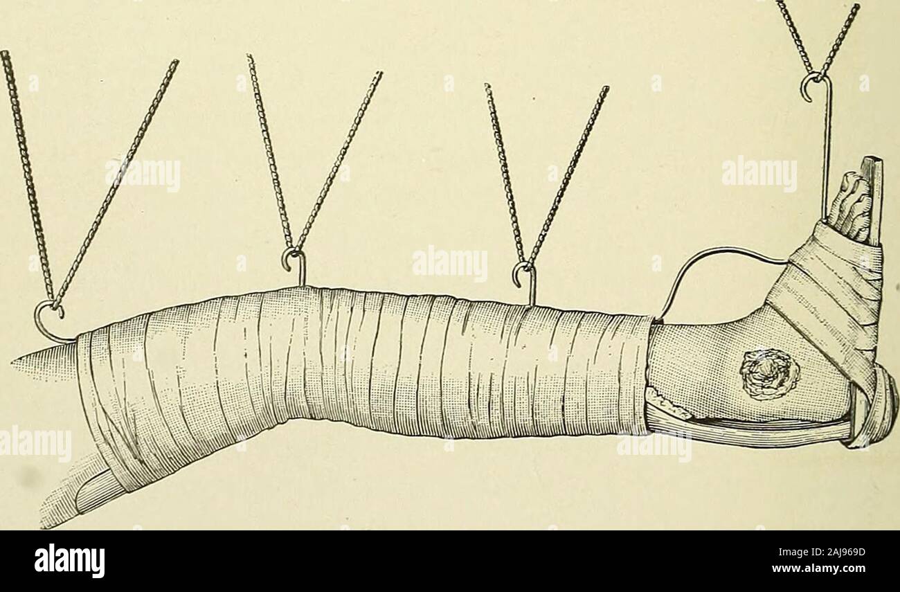 Preparatory and after treatment in operative cases . Fig. 384 ...