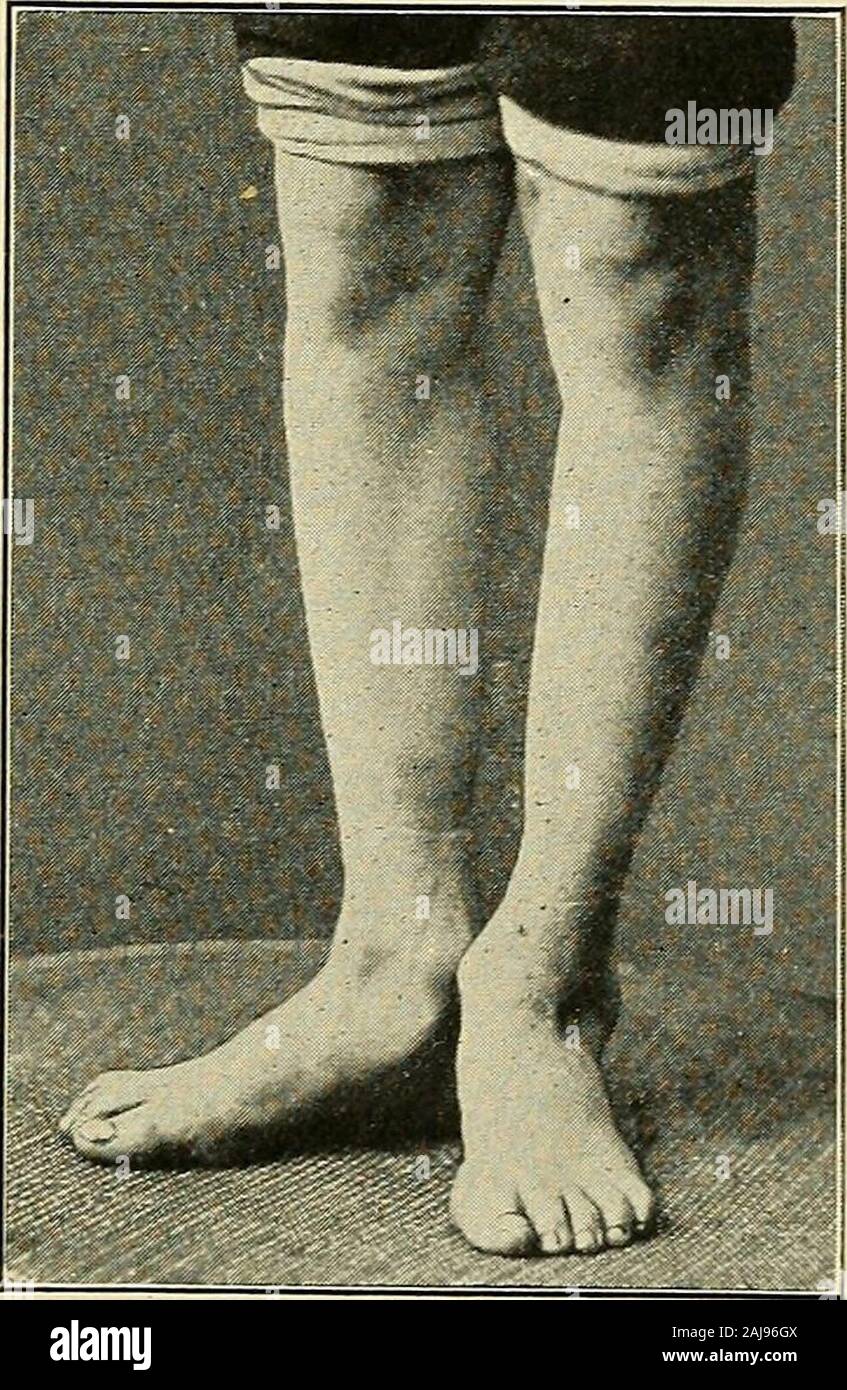 A treatise on orthopedic surgery . Weak feet, showing the ...