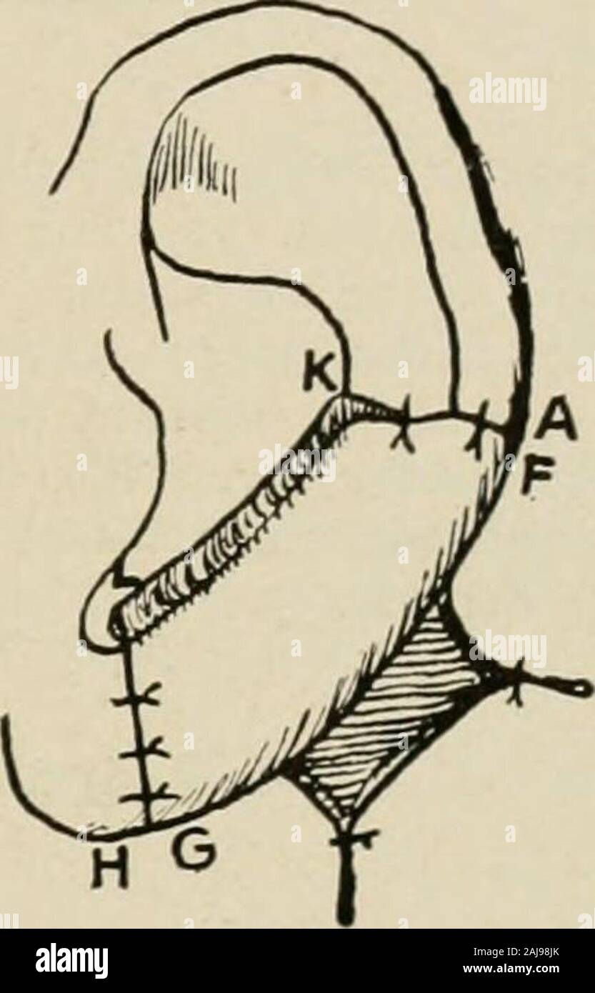 Plastic surgery; its principles and practice . Fig. 420.—Operation for ...