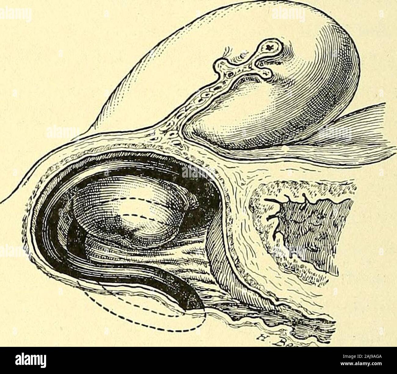 Operative gynecology : . Fig. 100.—Mundr Pessary or more properlyHodge ...