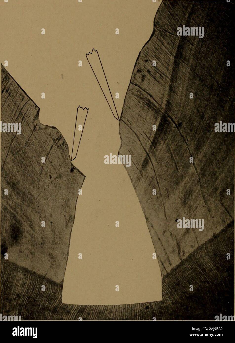 Cavity preparation hi-res stock photography and images - Alamy