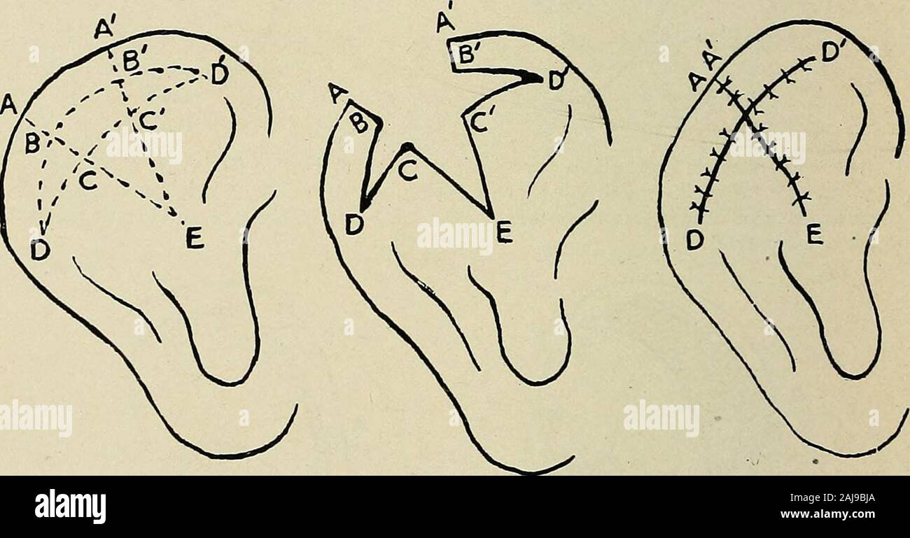 Plastic surgery; its principles and practice . th of thecrescent should ...