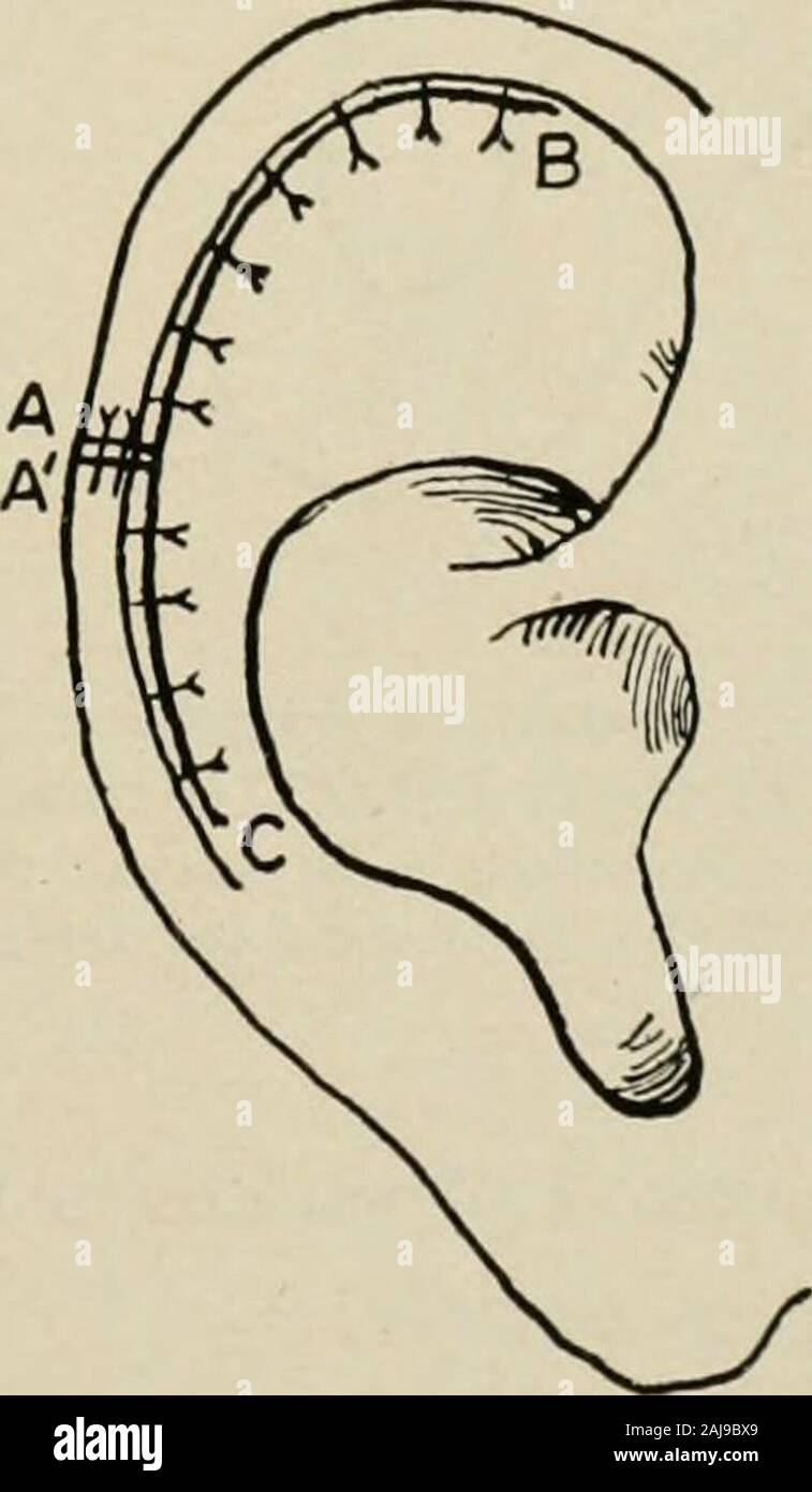 Plastic surgery; its principles and practice . Fig. 412.—Operation for ...