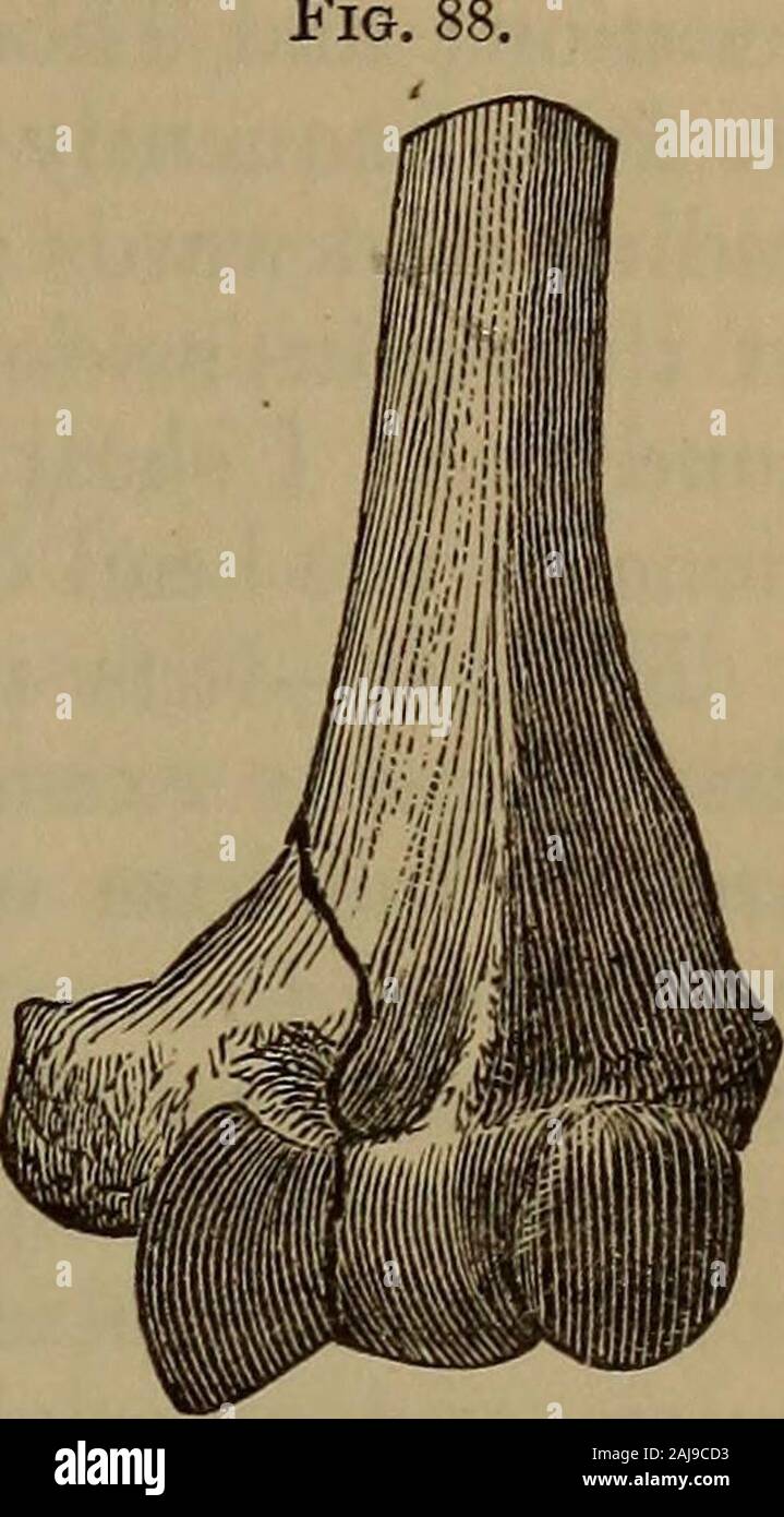 A practical treatise on fractures and dislocations . Fracture of ...