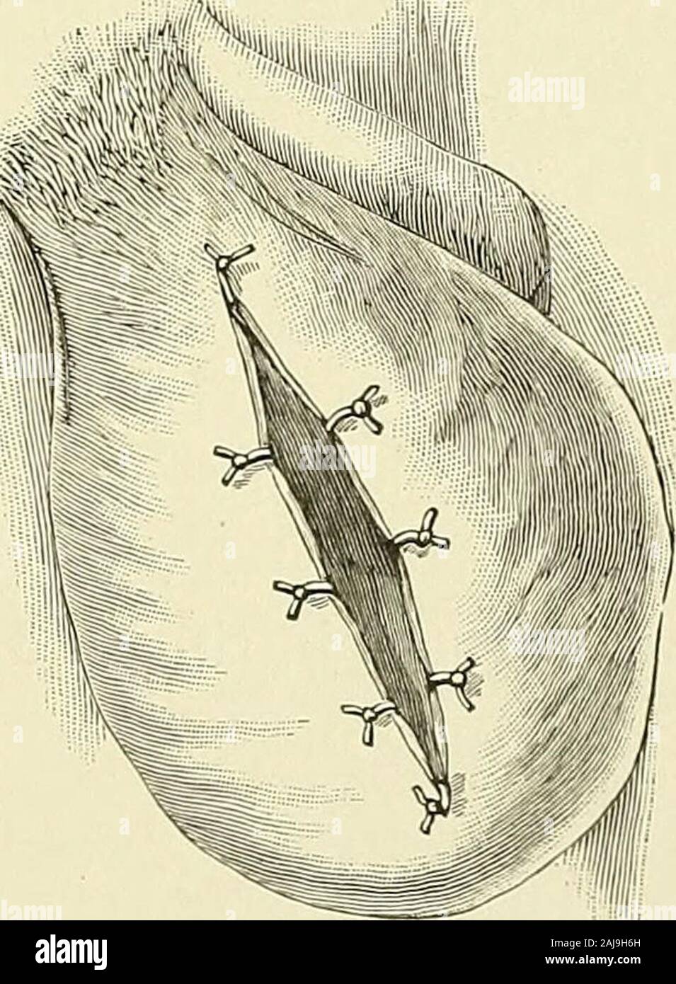 Non absorbable hi-res stock photography and images - Alamy