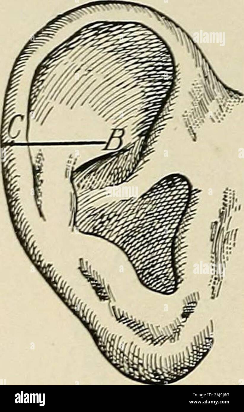 Plastic surgery; its principles and practice . Fig. 403.—Operation for ...