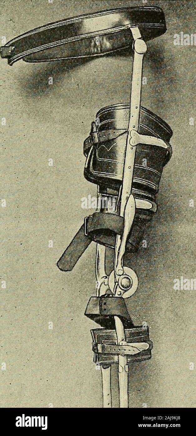 A treatise on orthopedic surgery . 3. O^ The Judson brace for paralysis ...